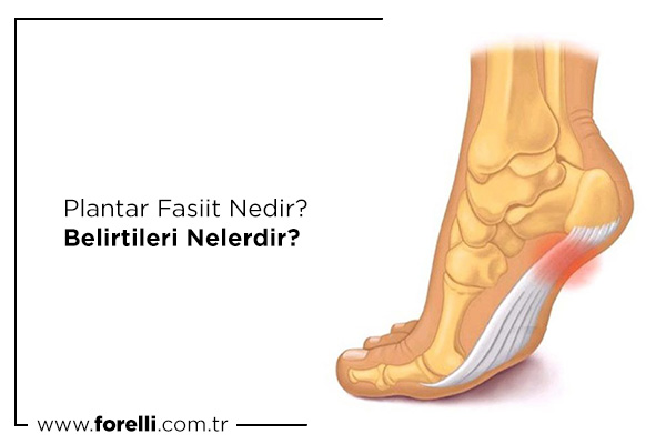 Plantar Fasiit Nedir? Belirtileri Nelerdir? | Forelli